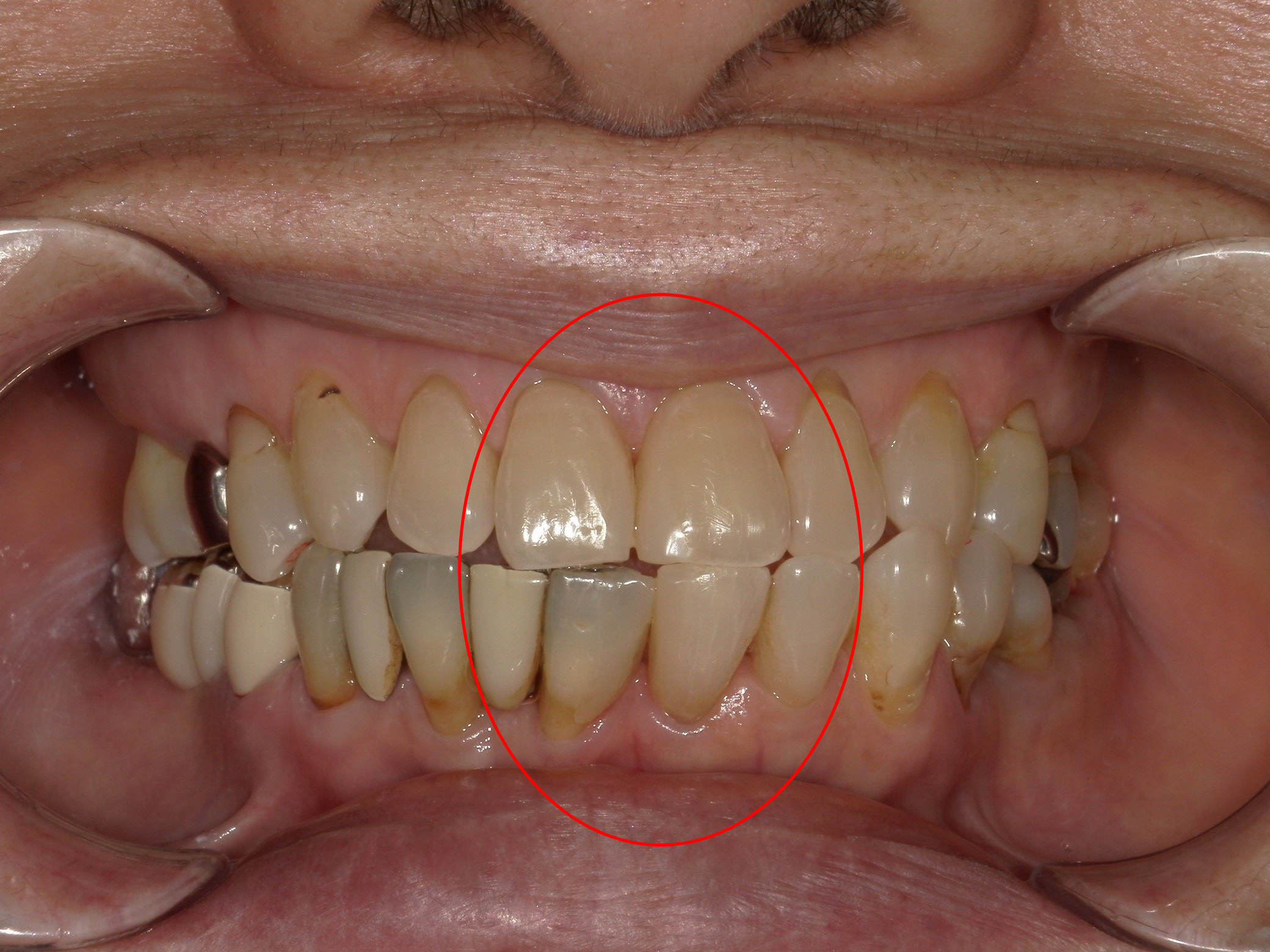 今治でダイレクトボンディングなら | ブライト歯科クリニック